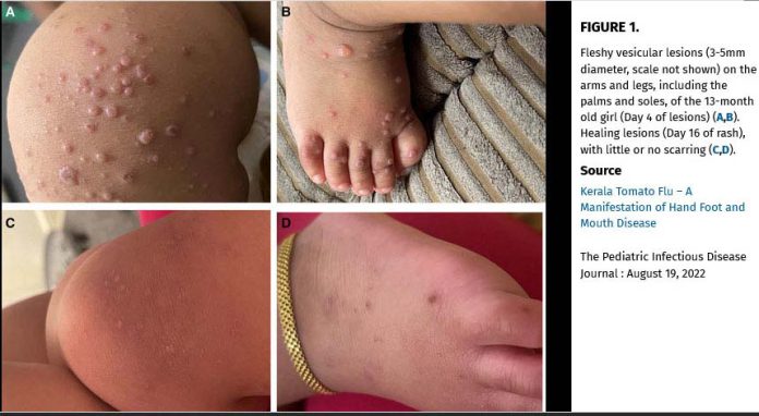 TOMATO VIRUS IN INDIA VS HAND, FOOT, AND MOUTH DISEASE (HFMD): WHAT IS ...